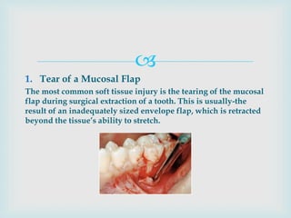 Complications of Extraction | PPTX