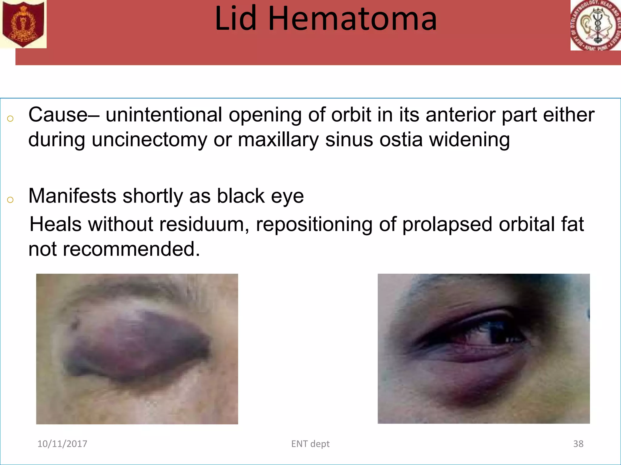 Complications of fess | PPTX