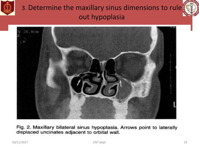 Complications of fess | PPTX
