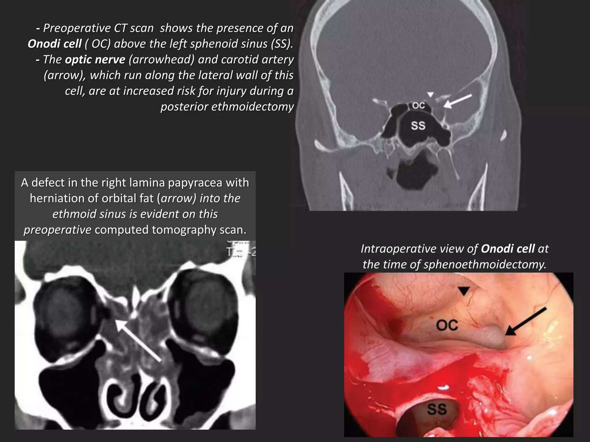 Complications of Endoscopic Sinus Surgery (ESS) | PPTX