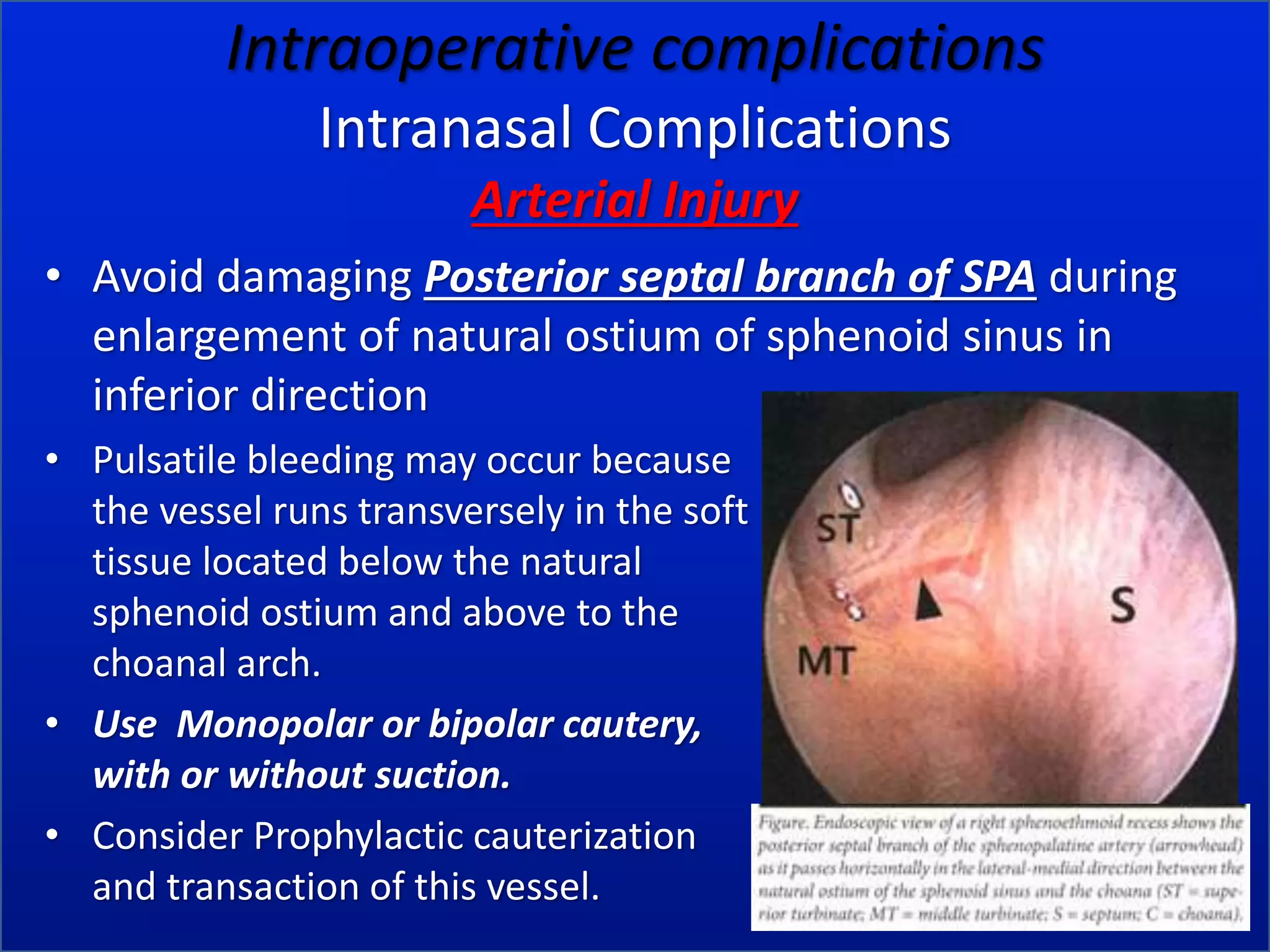 Complications of Endoscopic Sinus Surgery (ESS) | PPTX