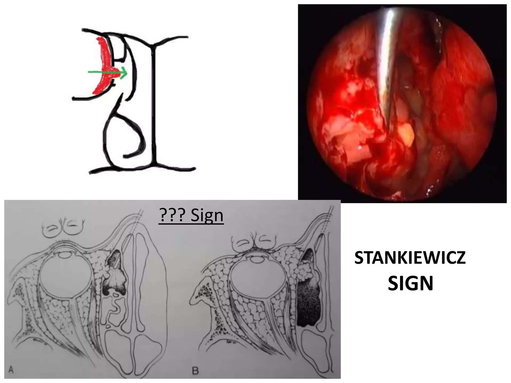 Complications of Endoscopic Sinus Surgery (ESS) | PPTX