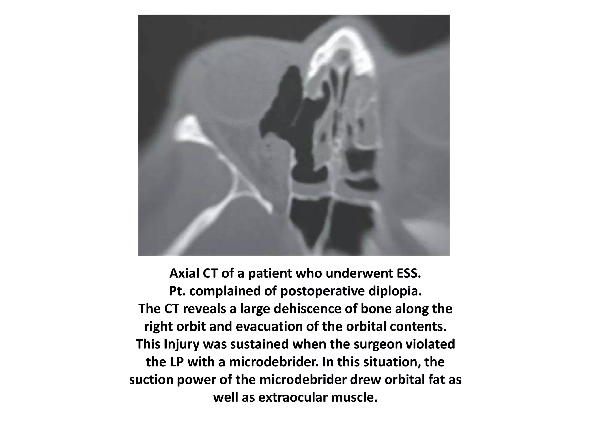 Complications of Endoscopic Sinus Surgery (ESS) | PPTX