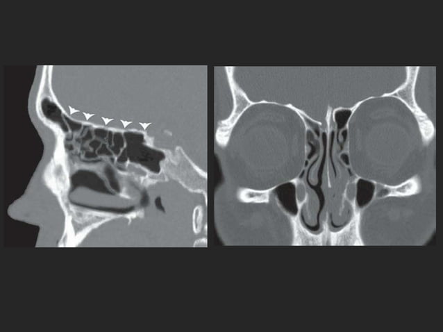 Complications of Endoscopic Sinus Surgery (ESS) | PPTX