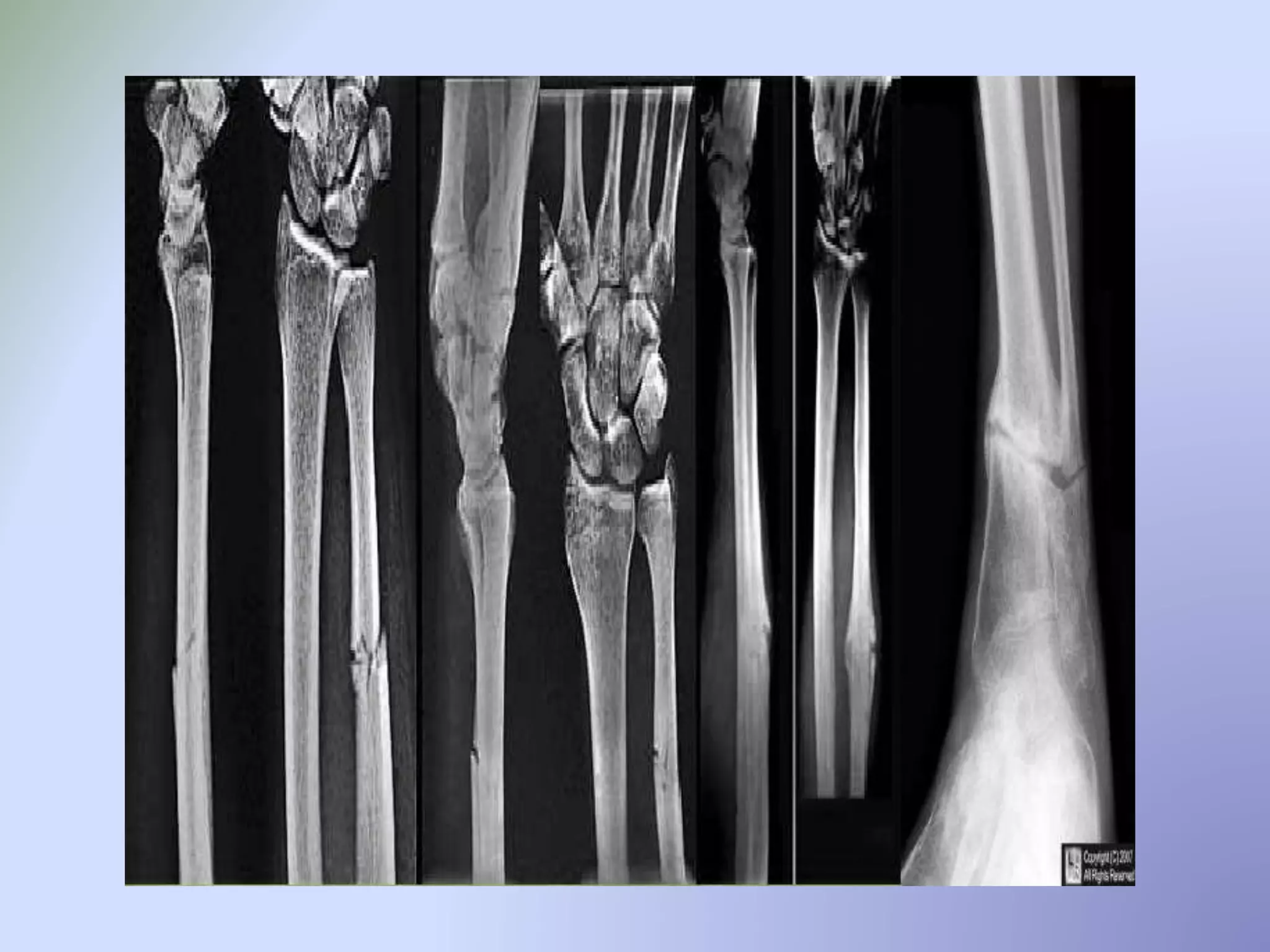 Complications of fractures of bones | PPT