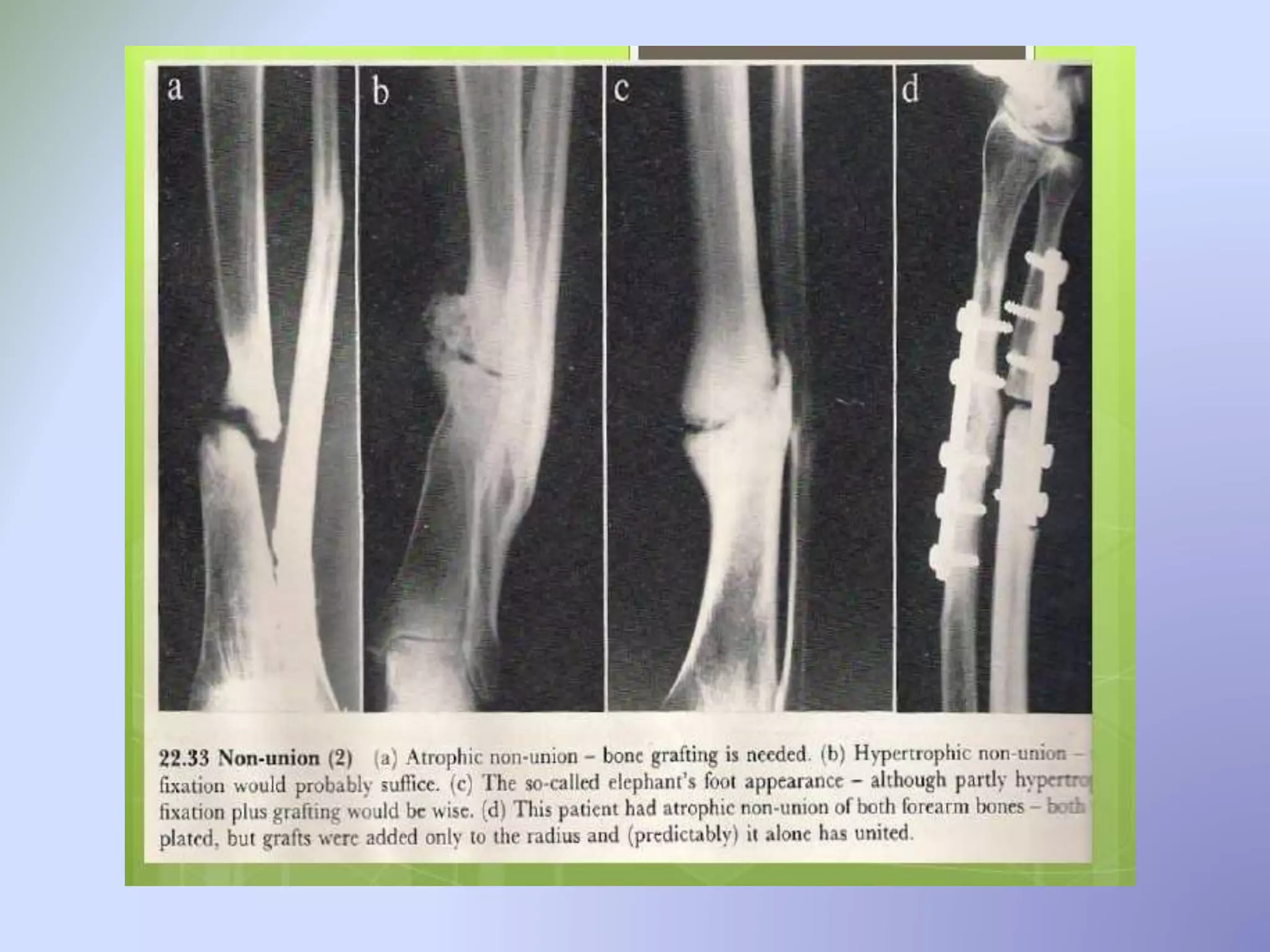 Complications of fractures of bones | PPT