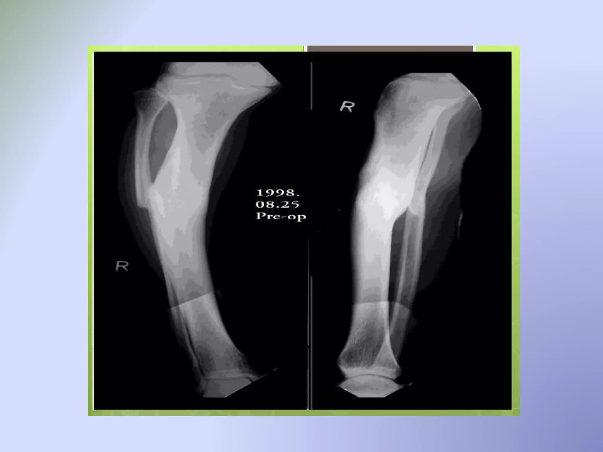 Complications of fractures of bones | PPT