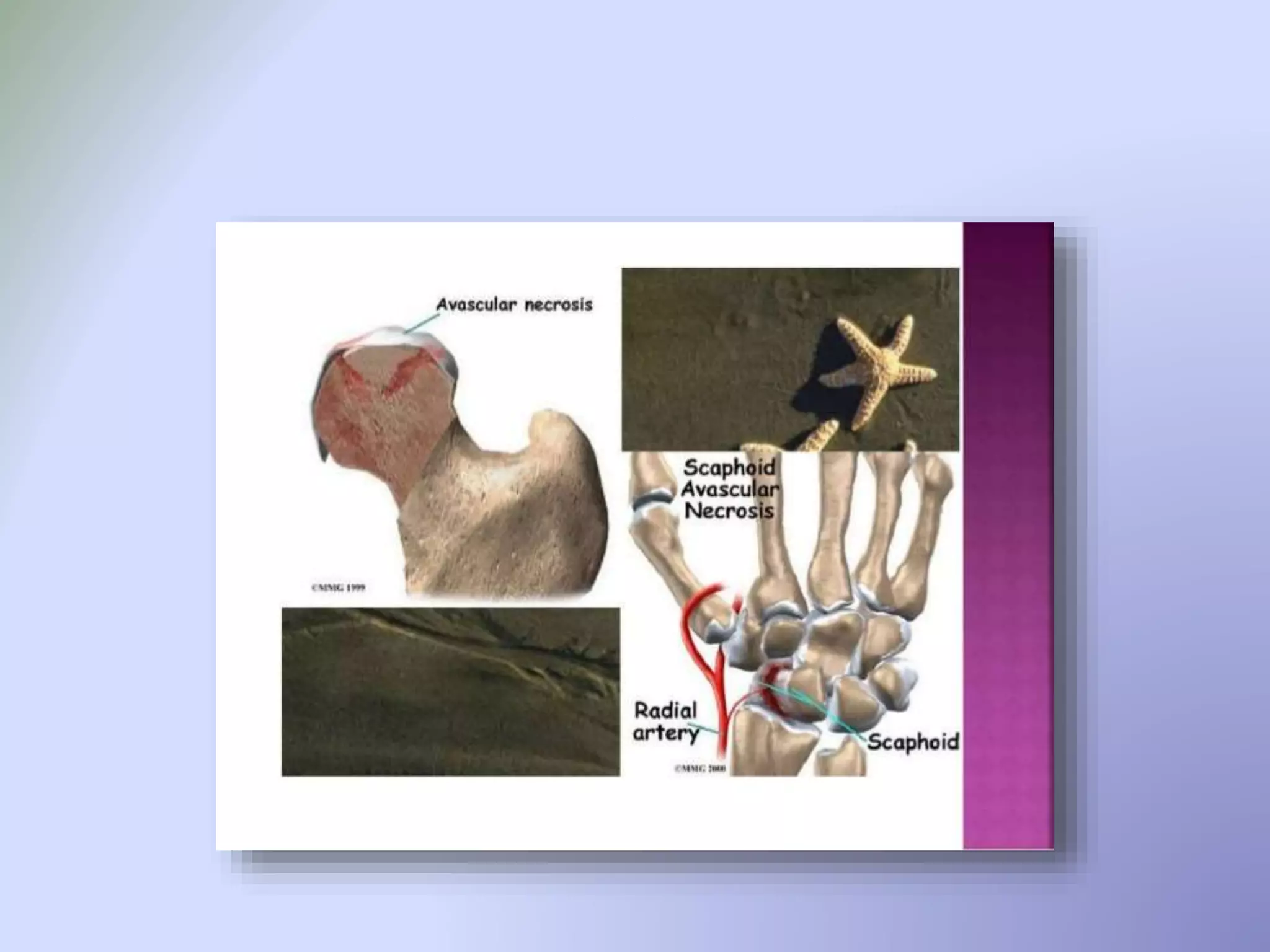 Complications of fractures of bones | PPT
