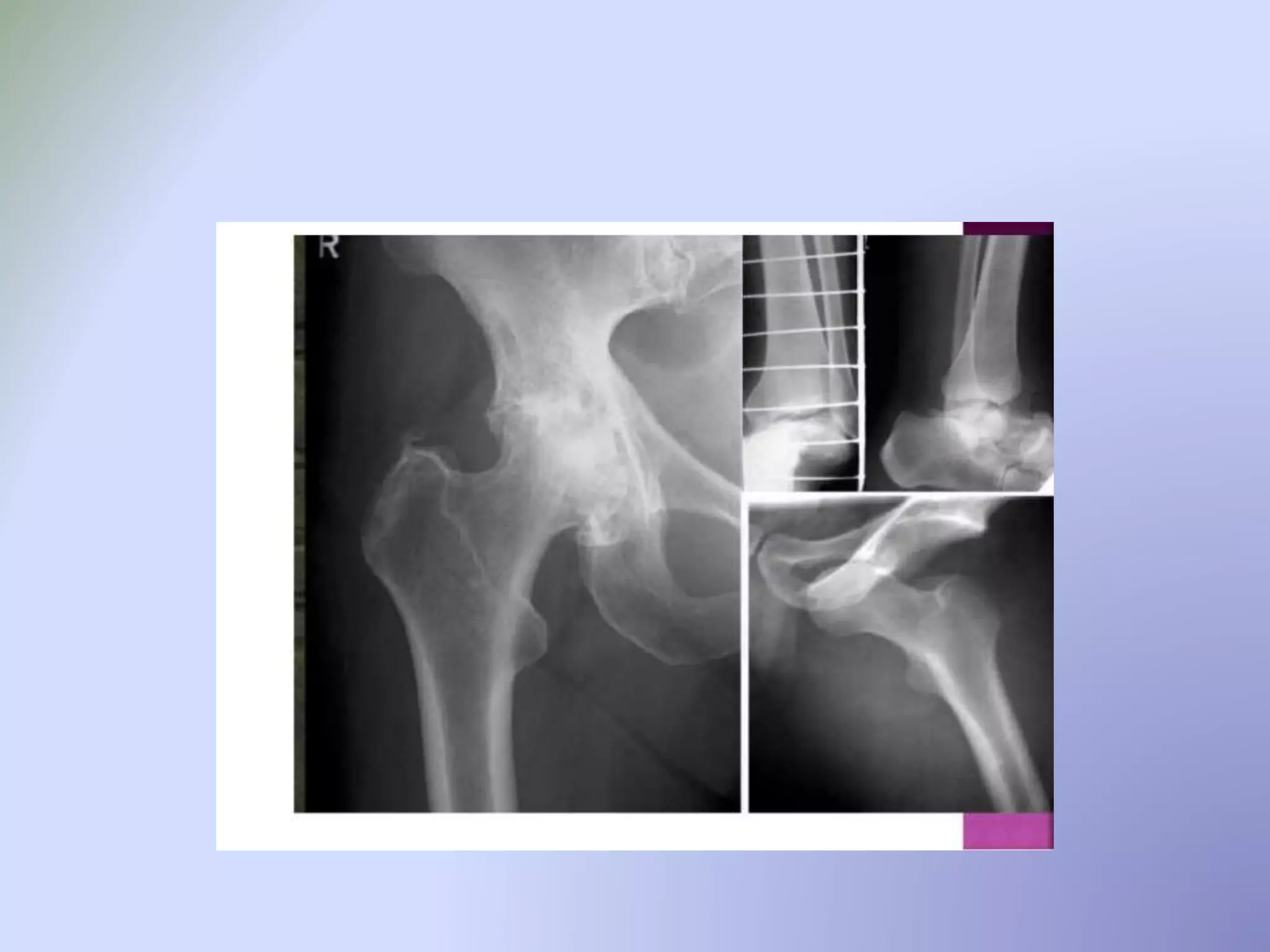 Complications of fractures of bones | PPT