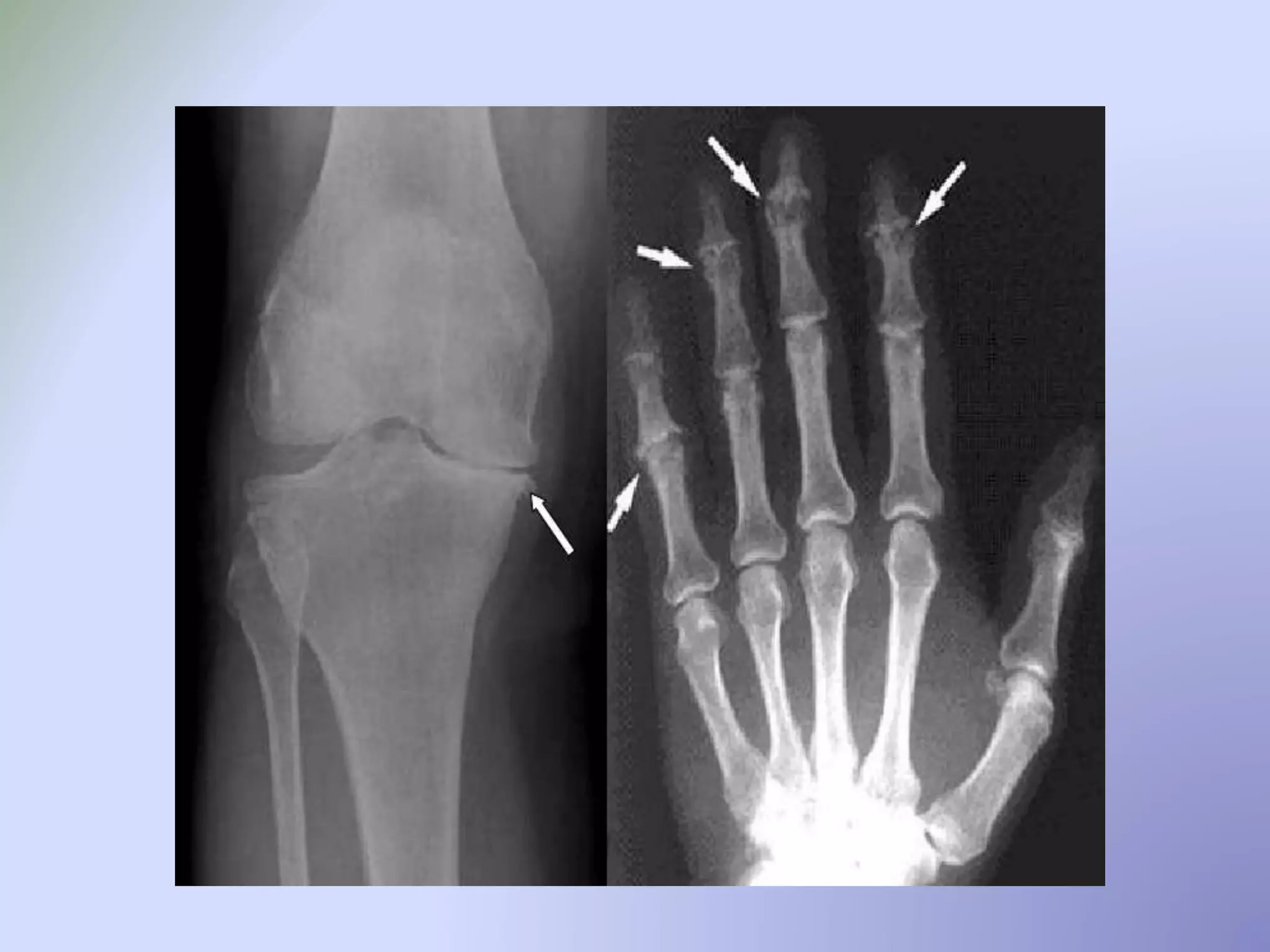 Complications of fractures of bones | PPT