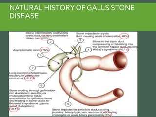 Complications of gall stones with all treatments.pptx