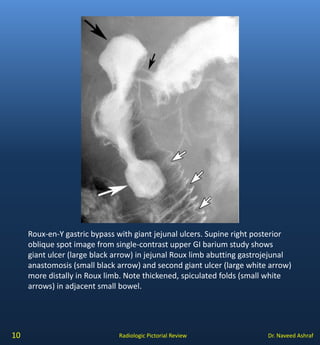Complications of gastric surgery | PDF