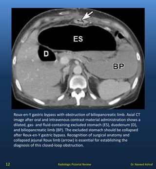 Complications of gastric surgery | PDF