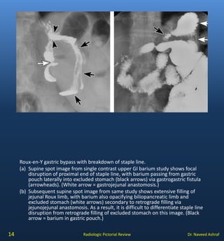 Complications of gastric surgery | PDF