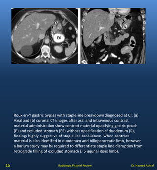 Complications of gastric surgery | PDF