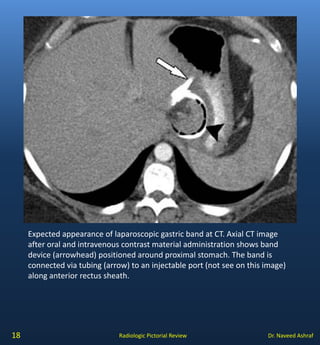 Complications of gastric surgery | PDF