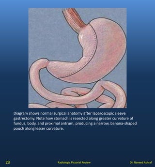 Complications of gastric surgery | PDF