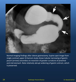 Complications of gastric surgery | PDF
