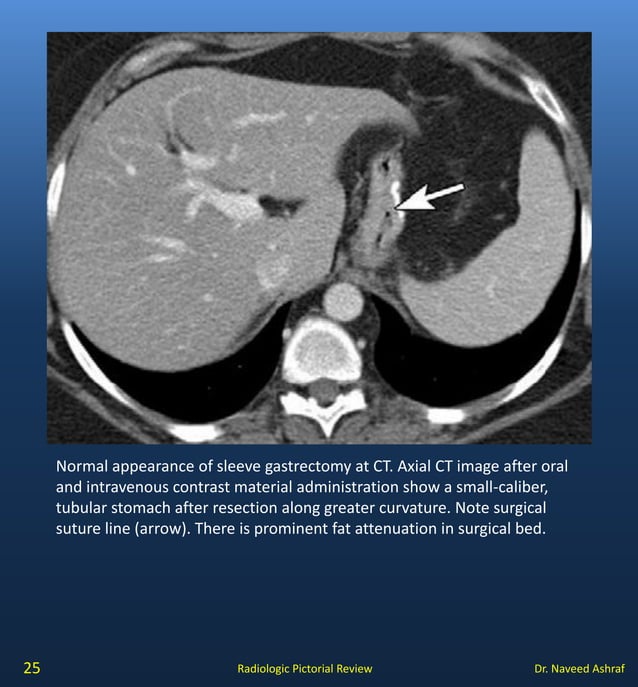Complications of gastric surgery | PDF