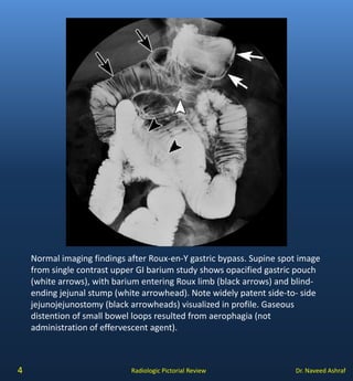 Complications of gastric surgery | PDF