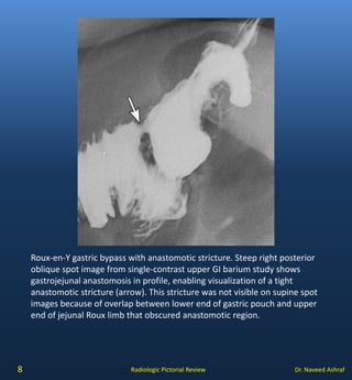 Complications of gastric surgery | PDF