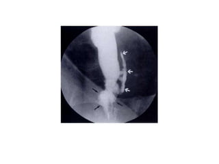 Complications of ipaa | PPTX