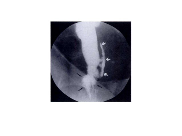 Complications of ipaa