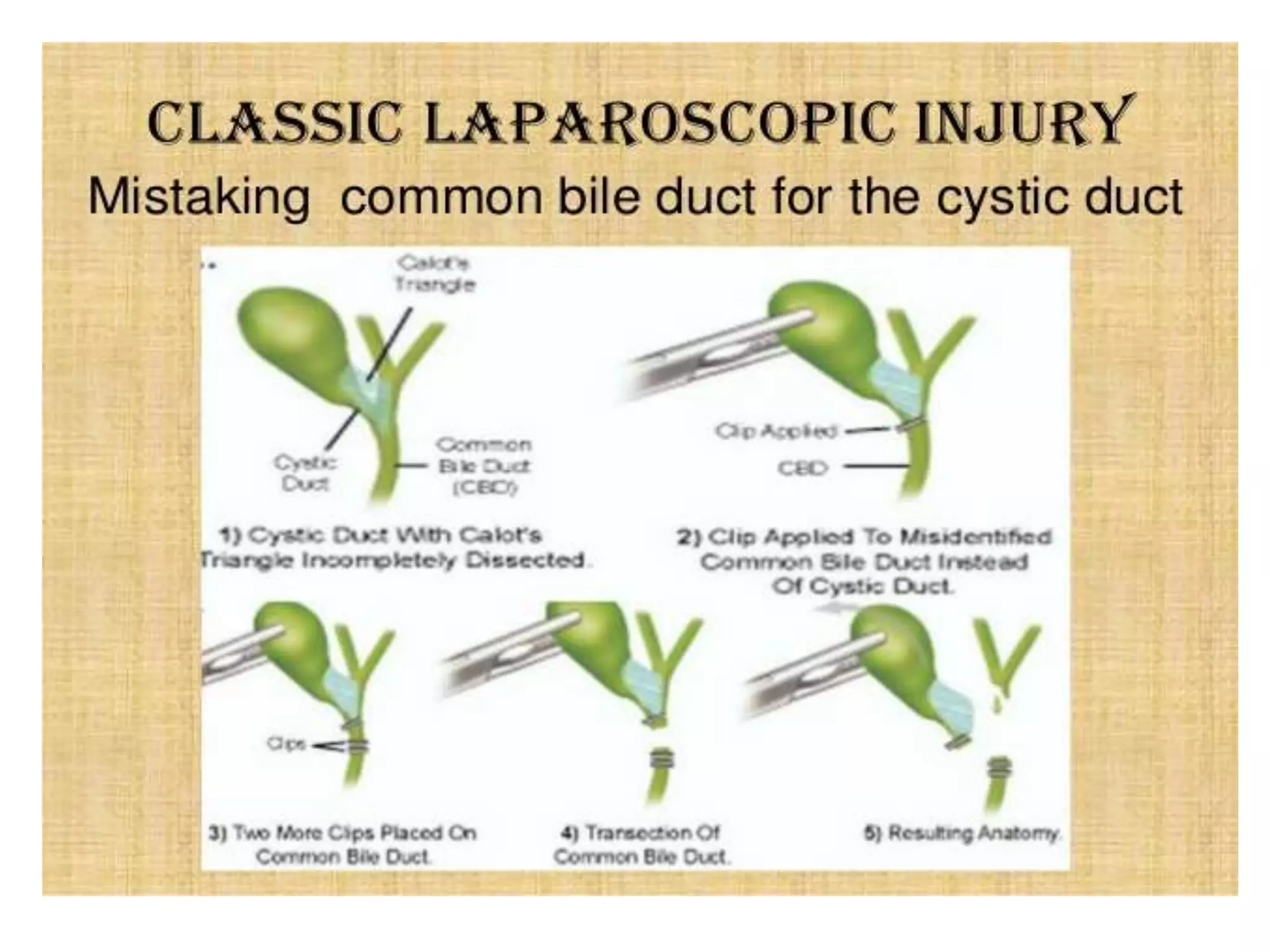 Complications of laparoscopic cholecystectomy, by Dr. Bashab Bijoy Roy ...
