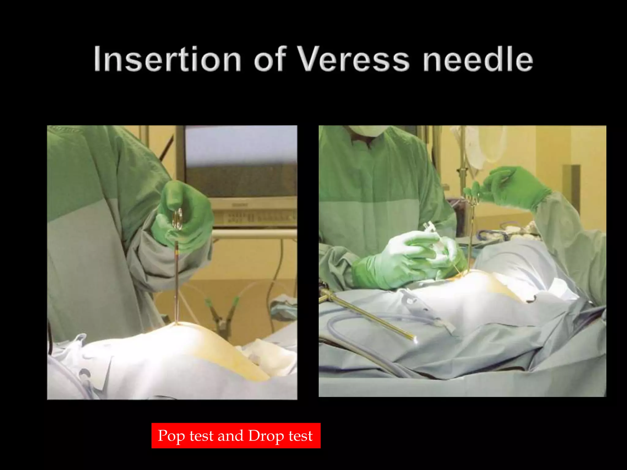 Complications of laparoscopy | PPTX