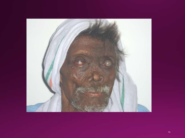 COMPLICATIONS OF LEPROSY & ITS MANAGEMENT | PPTX