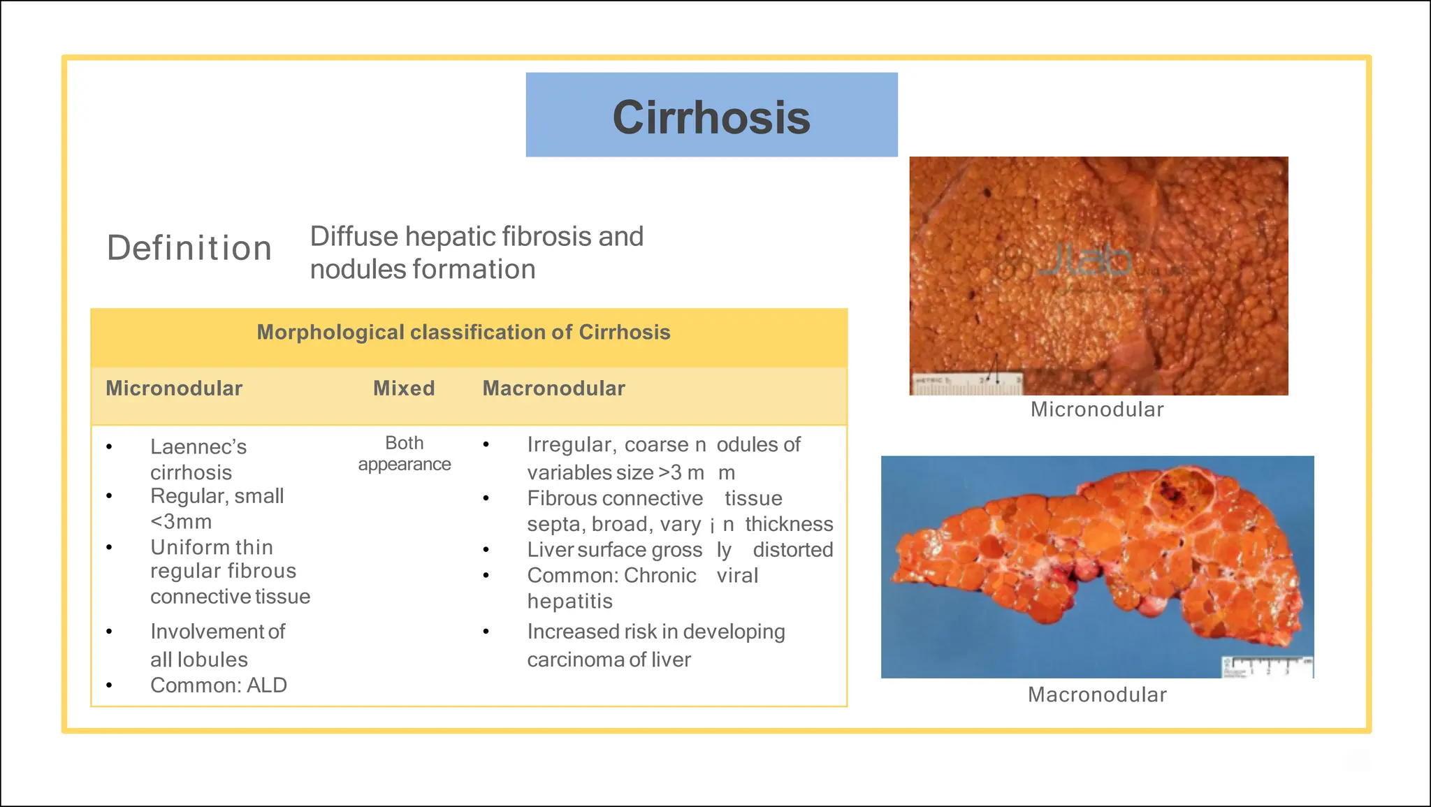 Complications of liver cirrhosis .pdf