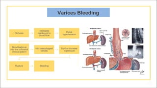 Complications of liver cirrhosis .pdf