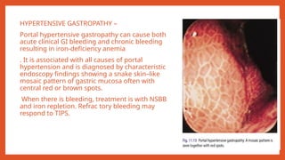 Complications of liver cirrhosis –ascites and portal [Autosaved].pptx