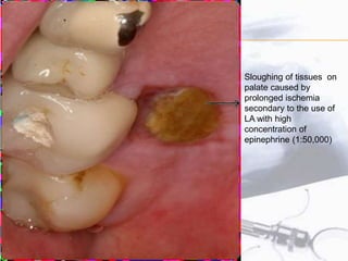 Complications of local anaesthesia | PPTX