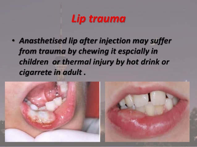 Complications of local anasthesia in dentistry