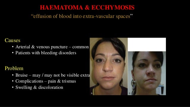 Complications of local anesthesia