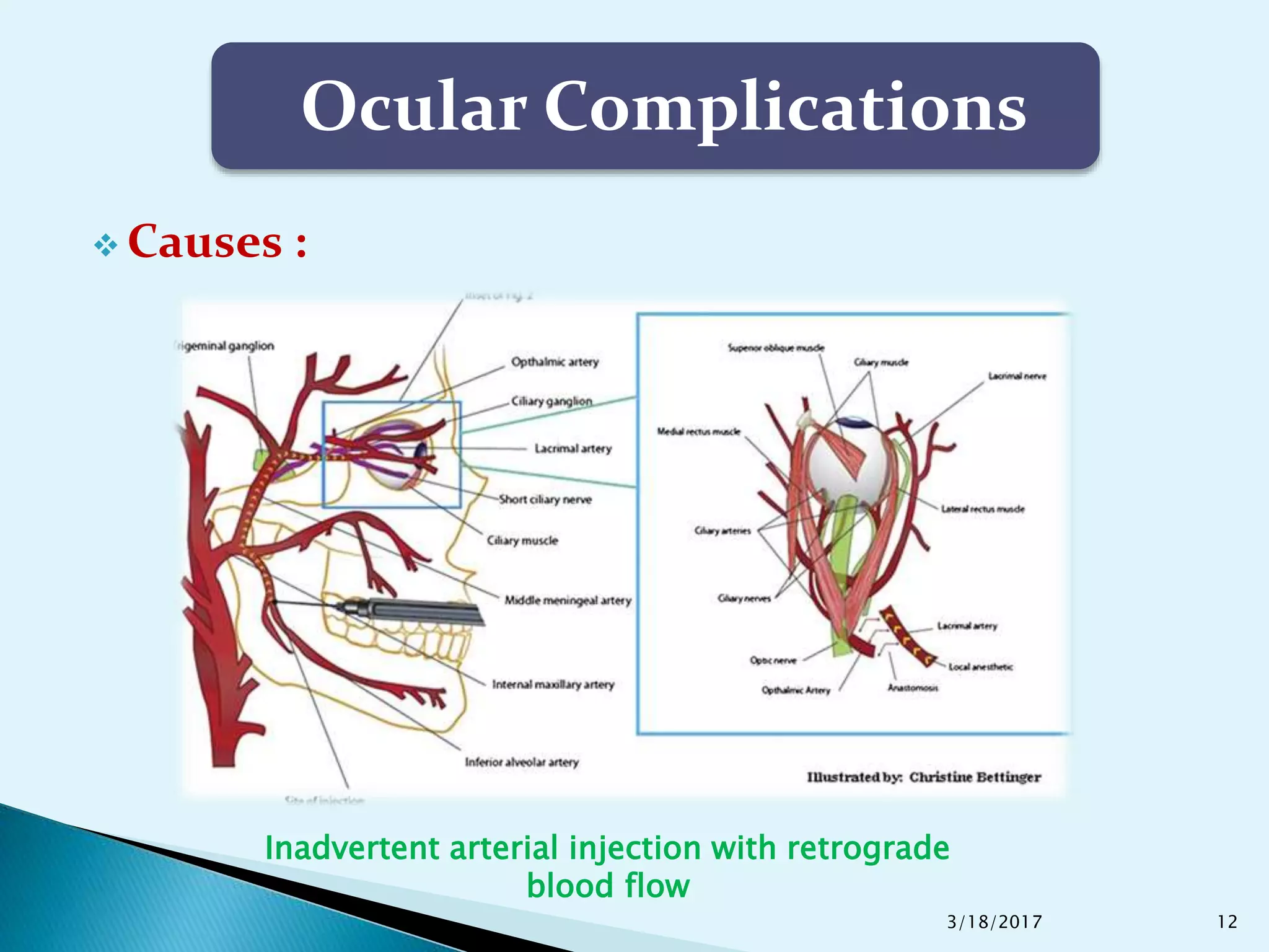 Complications of Local Anesthesia | PPTX