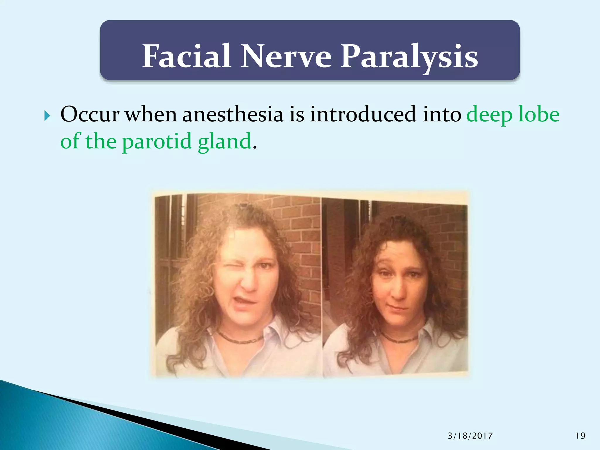Complications of Local Anesthesia | PPTX