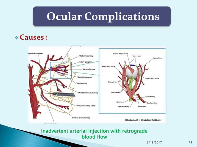 Complications of Local Anesthesia | PPTX | First Aid | Injuries
