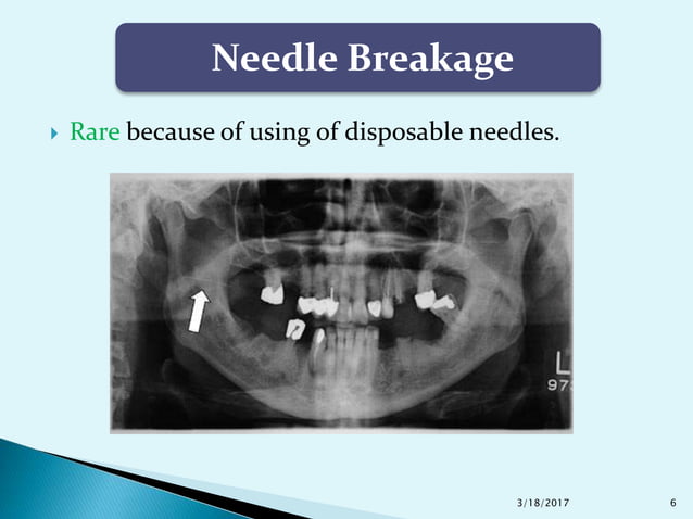 Complications of Local Anesthesia | PPTX | First Aid | Injuries
