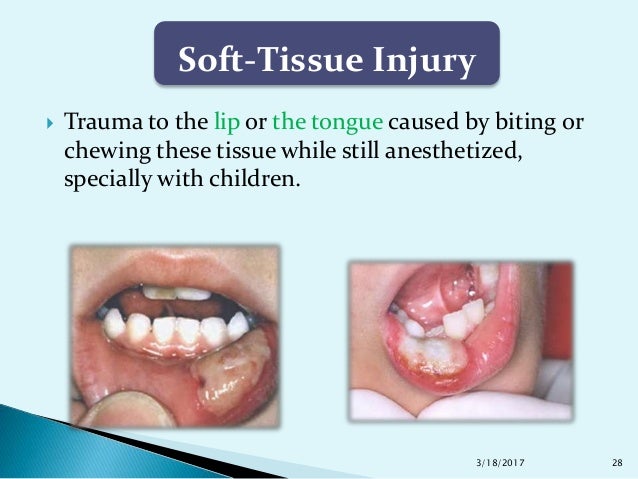 Complications of Local Anesthesia