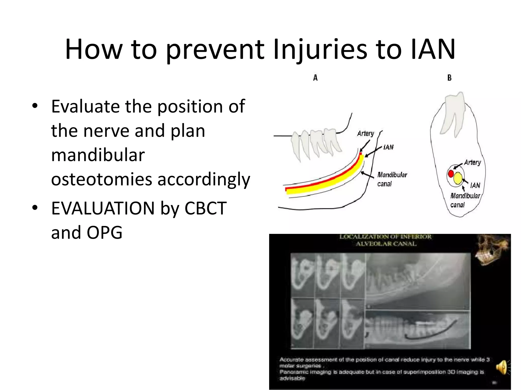 Complications of mandibular orthognathic surgery | PPTX