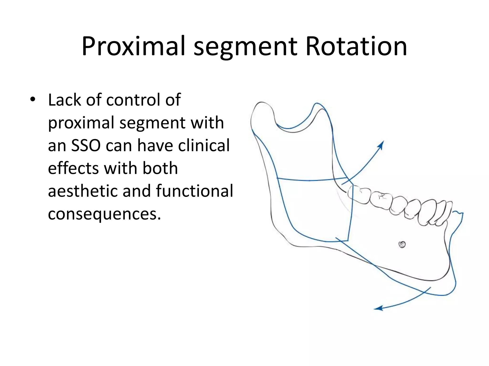 Complications of mandibular orthognathic surgery | PPTX