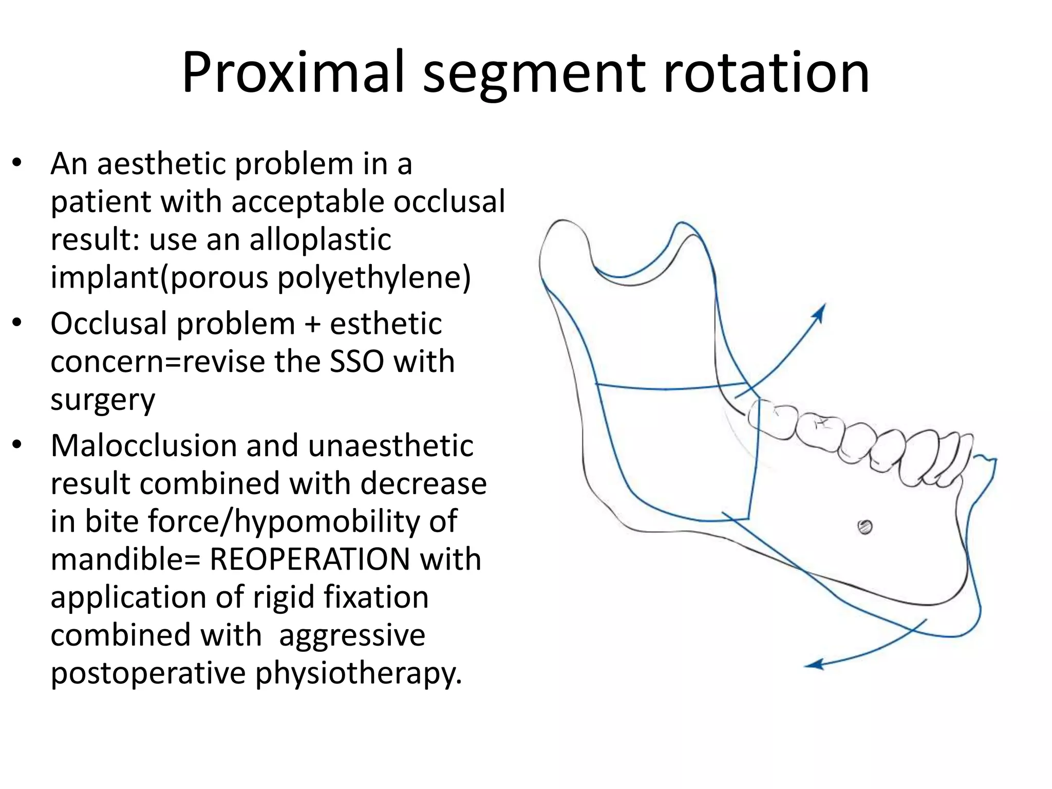 Complications of mandibular orthognathic surgery | PPTX
