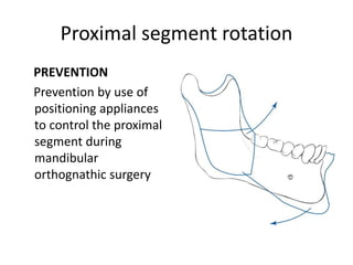 Complications of mandibular orthognathic surgery | PPTX