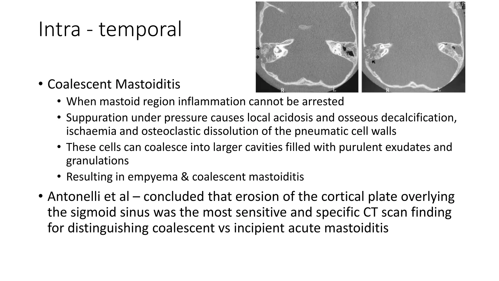 Complications of mastoiditis | PPTX