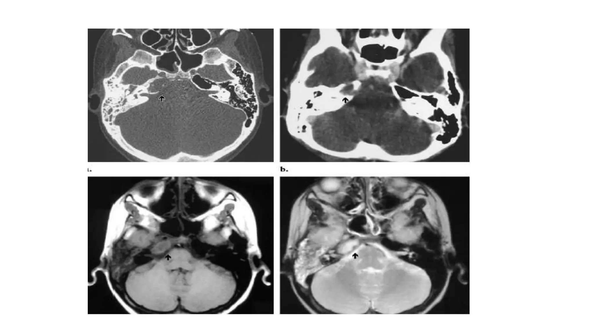 Complications of mastoiditis | PPTX