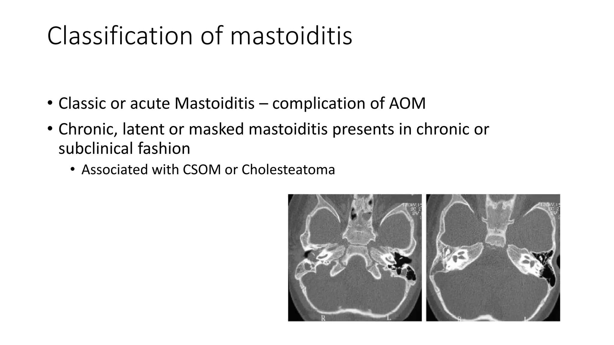 Complications of mastoiditis | PPTX