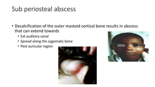 Complications of mastoiditis | PPTX