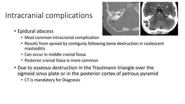 Complications of mastoiditis | PPTX | Ear, Nose and Throat Conditions ...